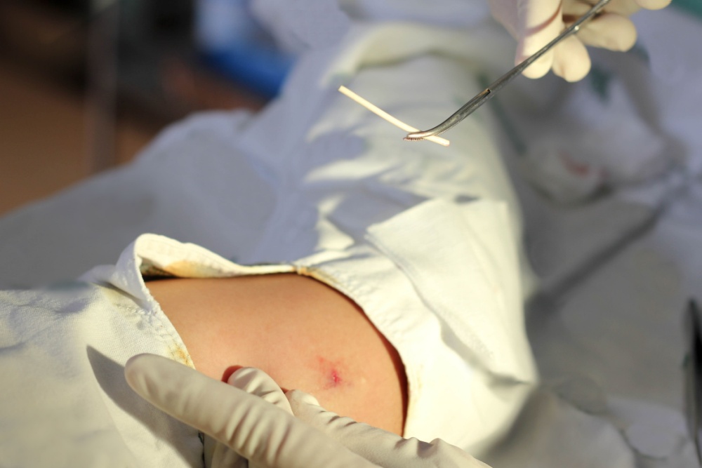 Implanon: quando é indicado e como funciona? - Dra. Priscila M.